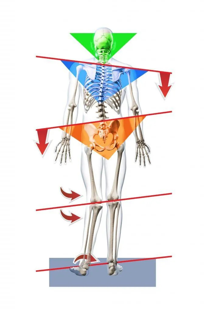Spine alignmelnt using custom orthotics. Can orthotics Help Reduce ...